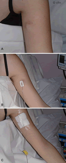 Port A Cath and lots of pain!!! - Ehlers-Danlos Syndromes